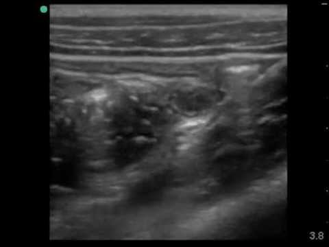 Normal Appendix on PoCUS in 6 y.o. Boy wth RLQ Pain - YouTube