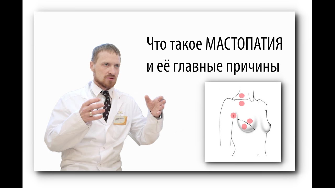 Что такое мастопатия? Причины мастопатии - YouTube