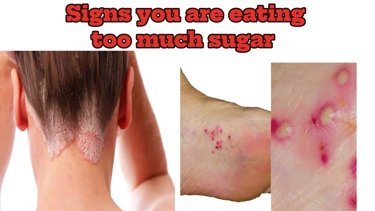 10 Warning Signs That You Are Eating Too Much Sugar / How To Stop ...