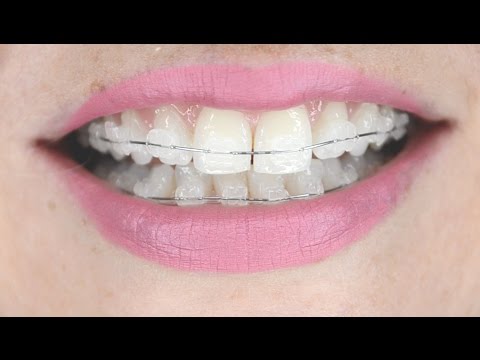 Adult Braces Close Up - Day 4 Vlog (No.2)