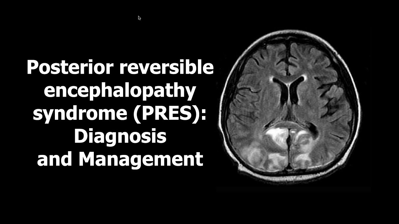Posterior Reversible Encephalopathy Syndrome Radiology