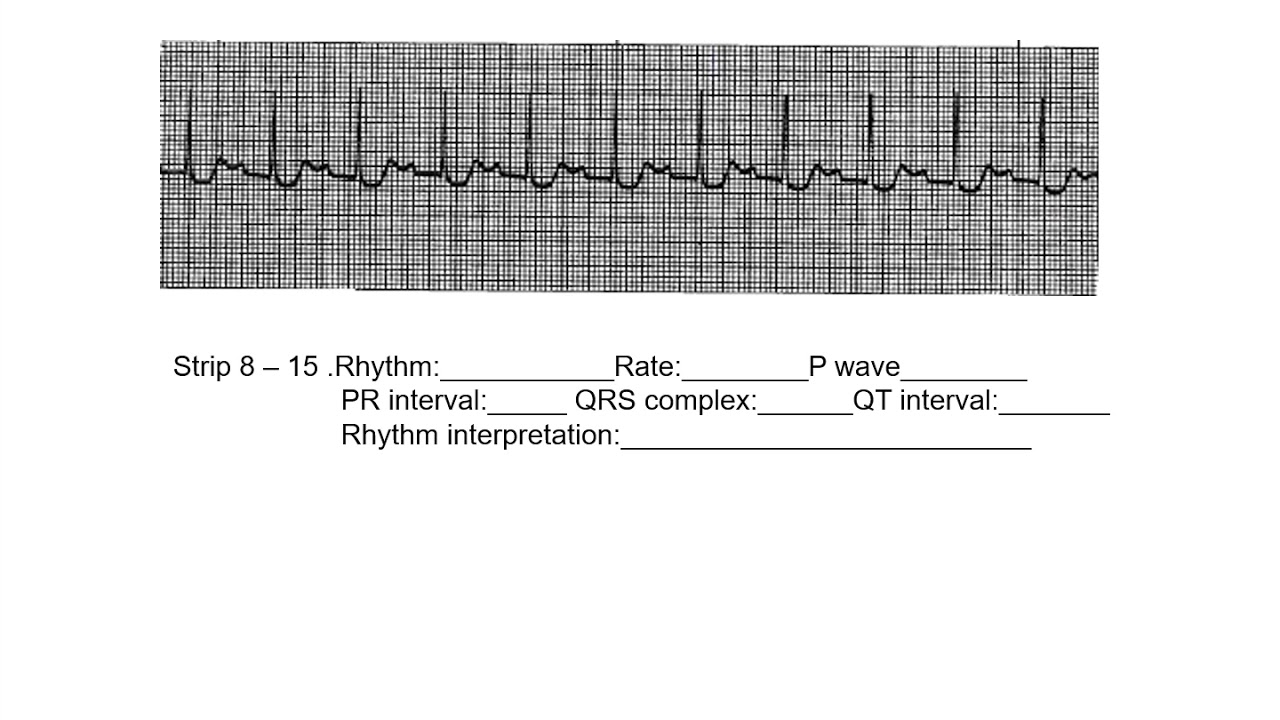 AV blocks, ventricular, and pacemaker homework review video - YouTube