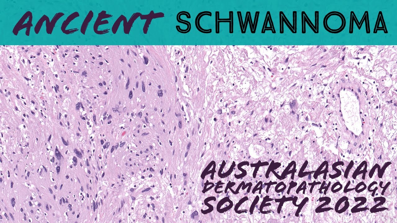 Schwannoma Histology