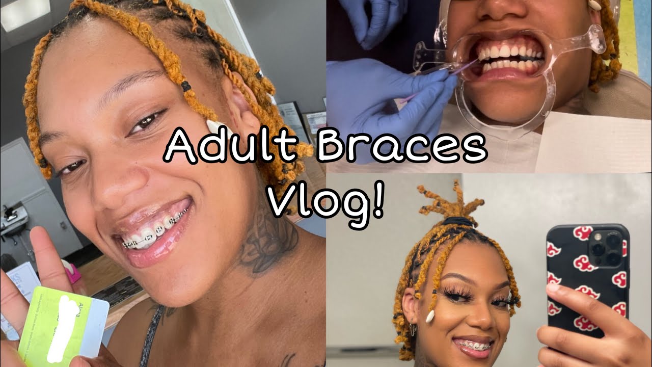 BRACES VLOG 1 | Come with me to get braces! | Adult Braces - YouTube