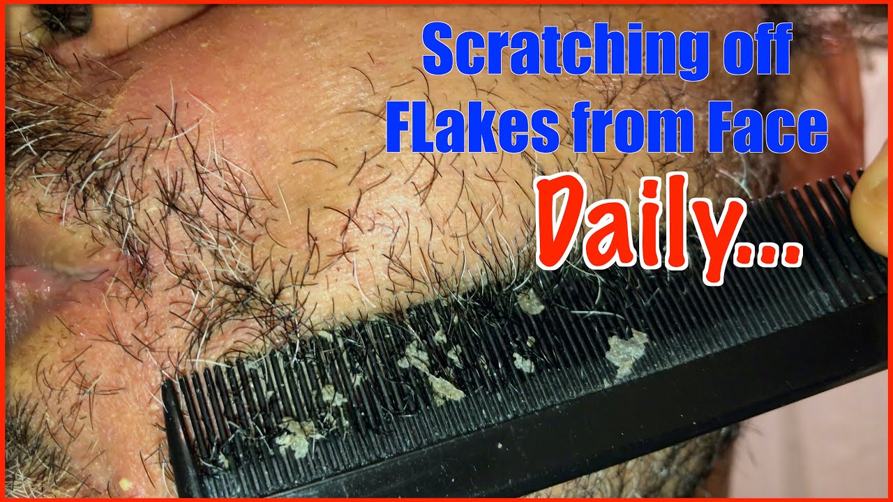 Morning Routine 2020 | DANDRUFF FLAKES | SEBORRHEIC DERMATITIS ...