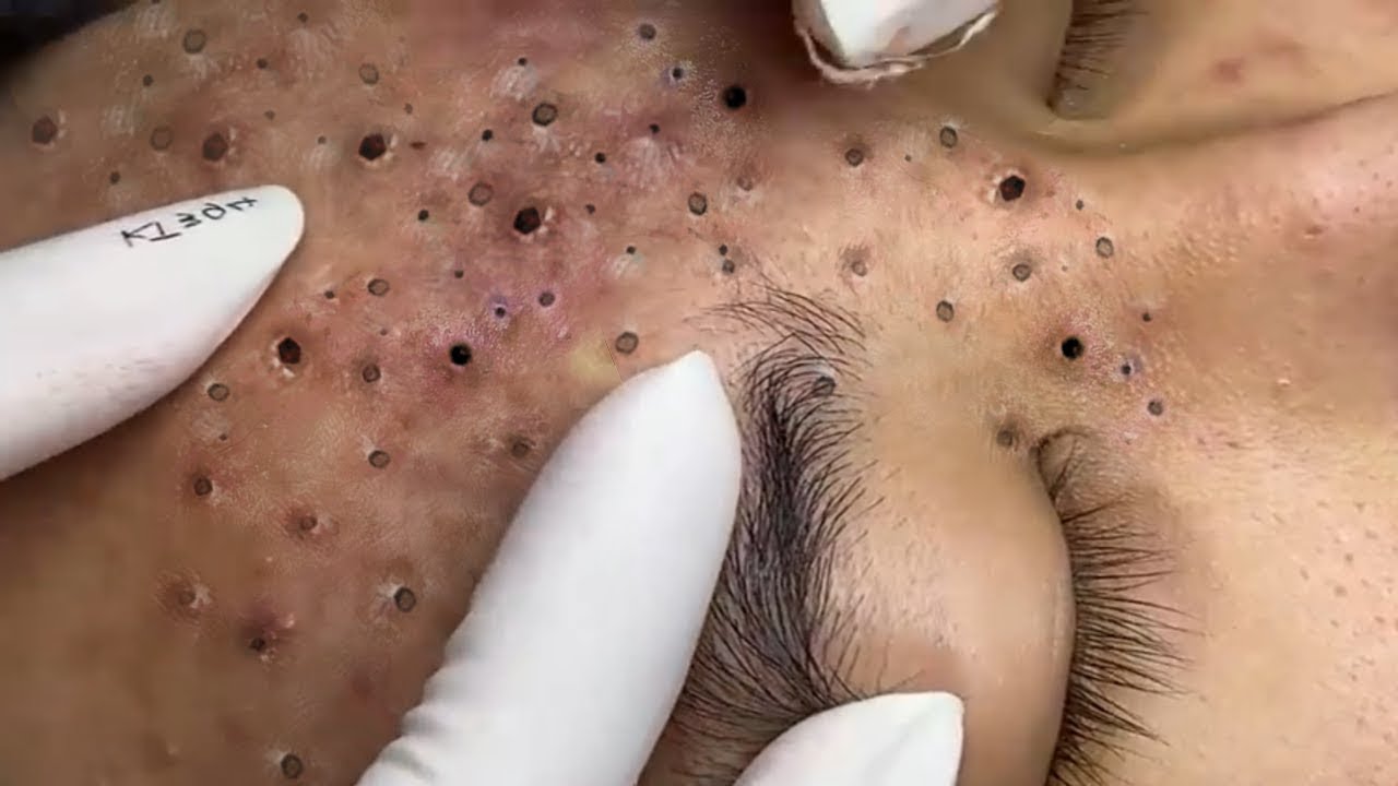 Big Cystic Acne Blackheads Extraction Blackheads & Milia, Whiteheads ...