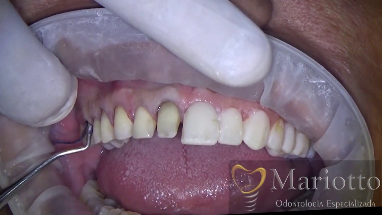 Preparo para Reabilitação - Facetas, coroas e onlays - YouTube