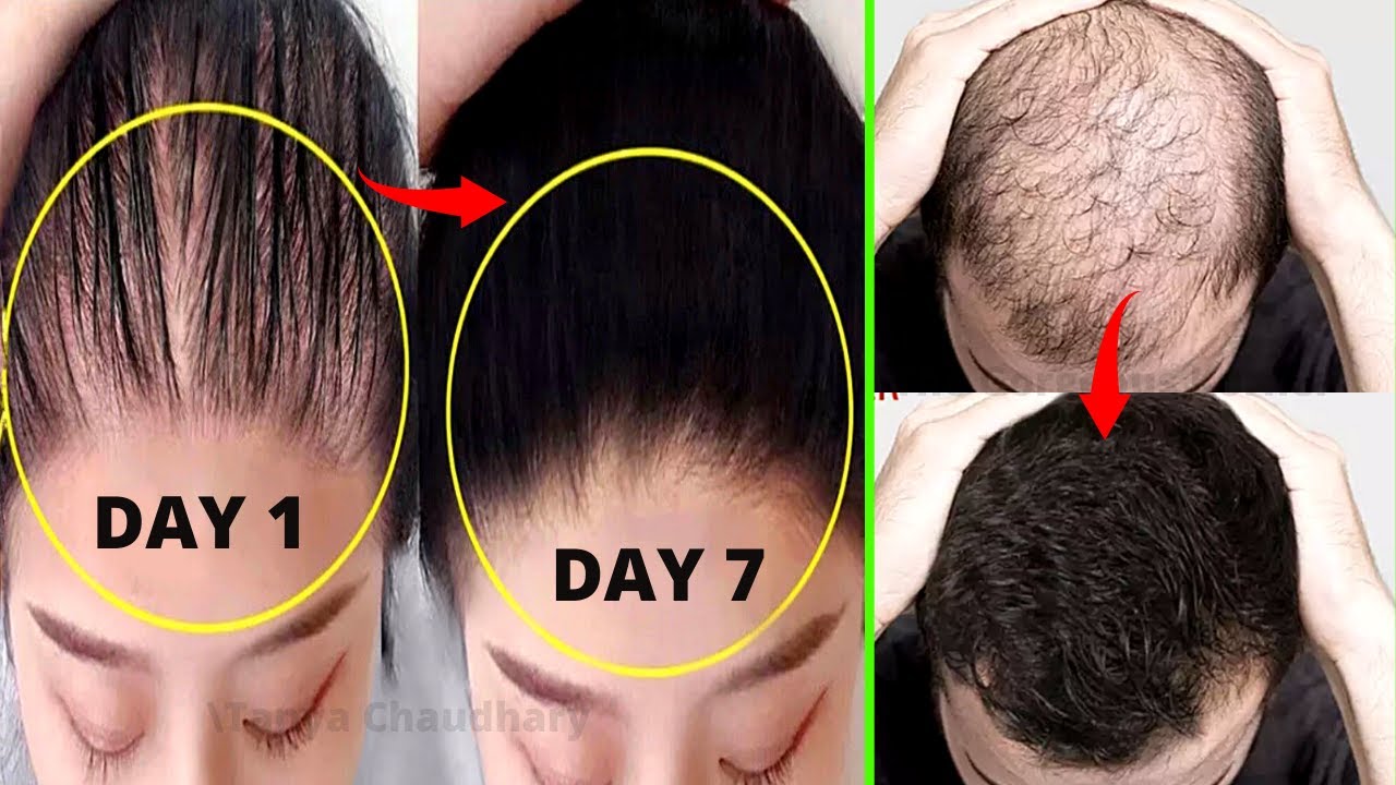How To Grow Hair Super Fast in 7 Days | Treat Hair Fall, Hair Loss ...