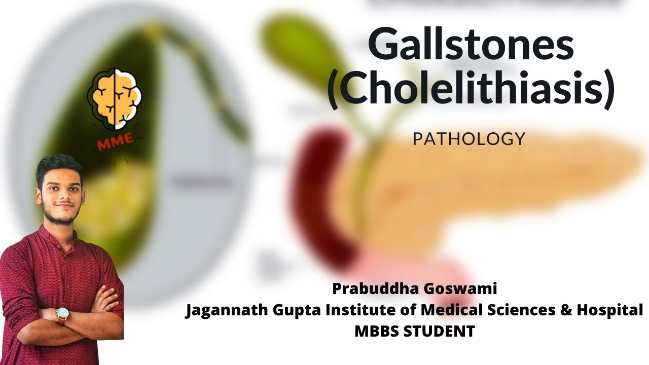 Gallstones (Cholelithiasis)| PATHOLOGY | Prabuddha Goswami | Make ...