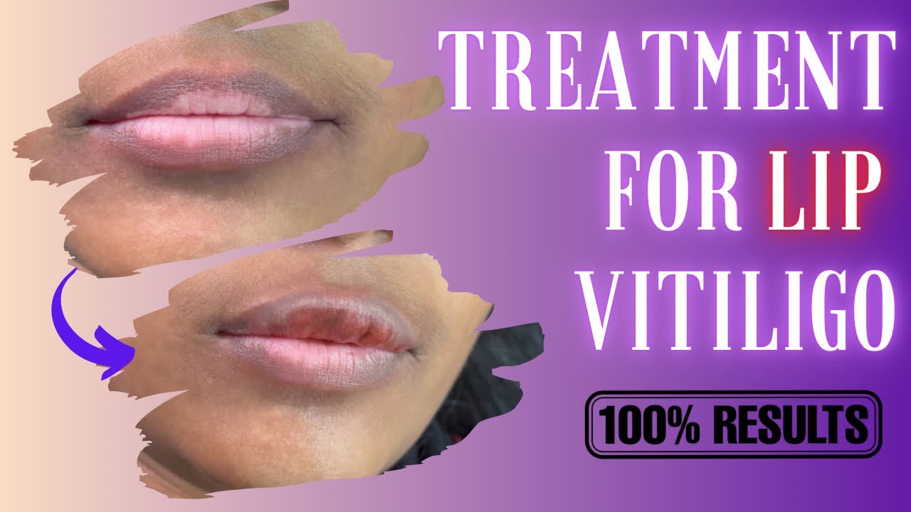 Lip vitiligo treatment | 100% results | no side effects | Bangalore ...