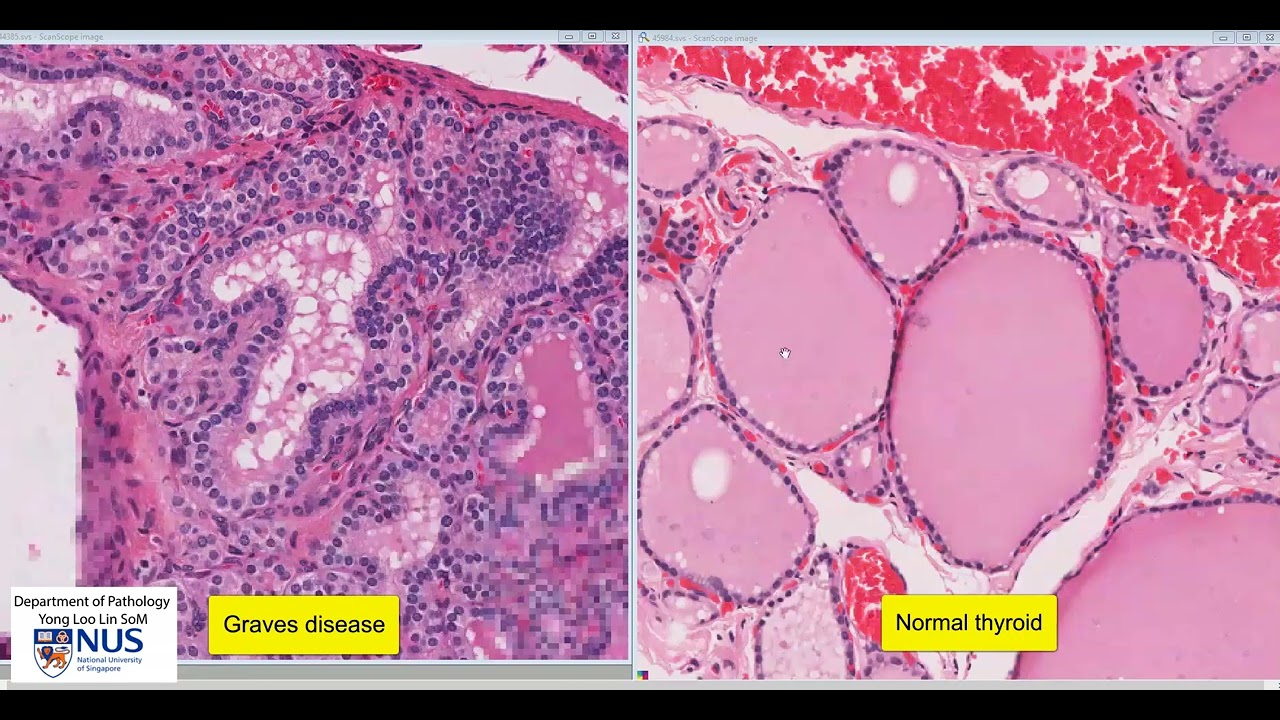 Thyroid Graves Disease Micrscopy Talking Slide YouTube thyroid-graves-disease-micrscopy-talking-slide-youtube