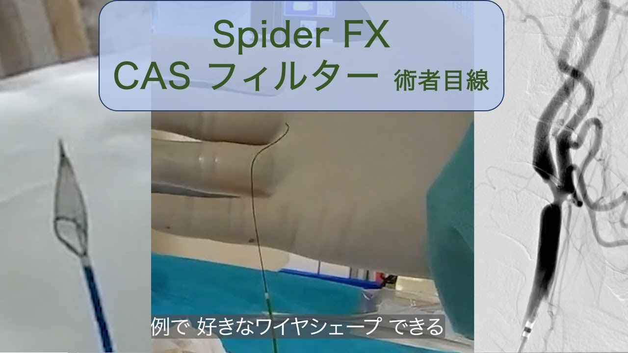 Spider FX 頚動脈ステント(CAS) 用フィルタの使い方 術者目線 version 2022 - YouTube