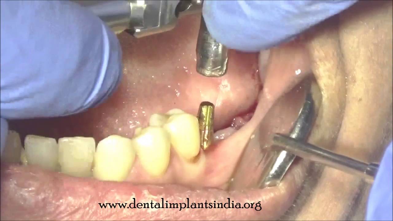 Lower molar teeth immediate basal implants-immediate loading with genxt ...