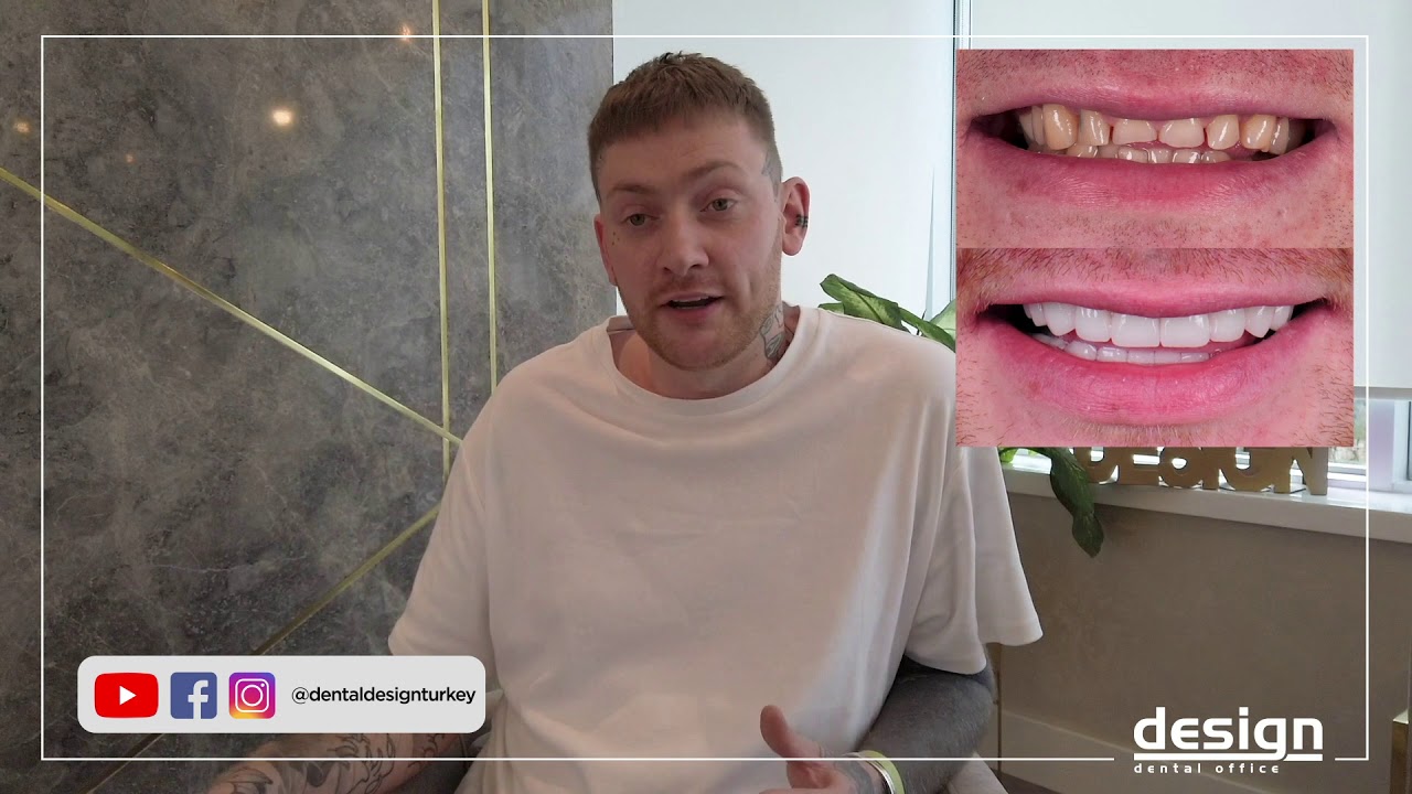 Richard Cawkwell Smile Makeover Experience in Antalya ( I got veneers ...