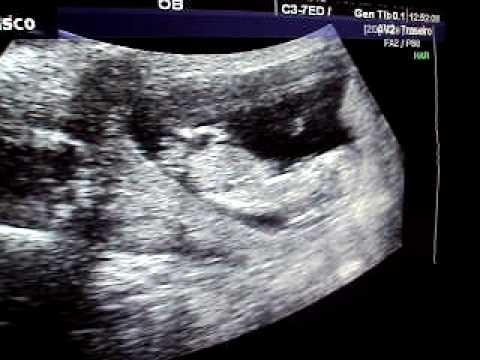 Nosso bebê! 12 semanas. - YouTube