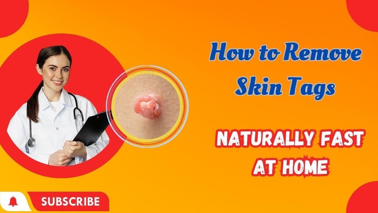 How to Remove Skin Tags Naturally Fast at Home - YouTube