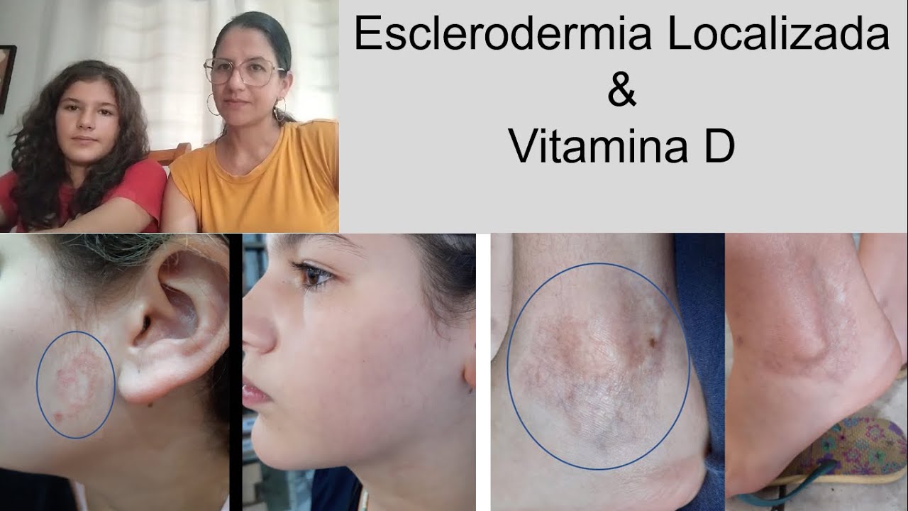 Morfeia Localizada ESCLERODERMIAS JUVENIS – Tratado De Clínica