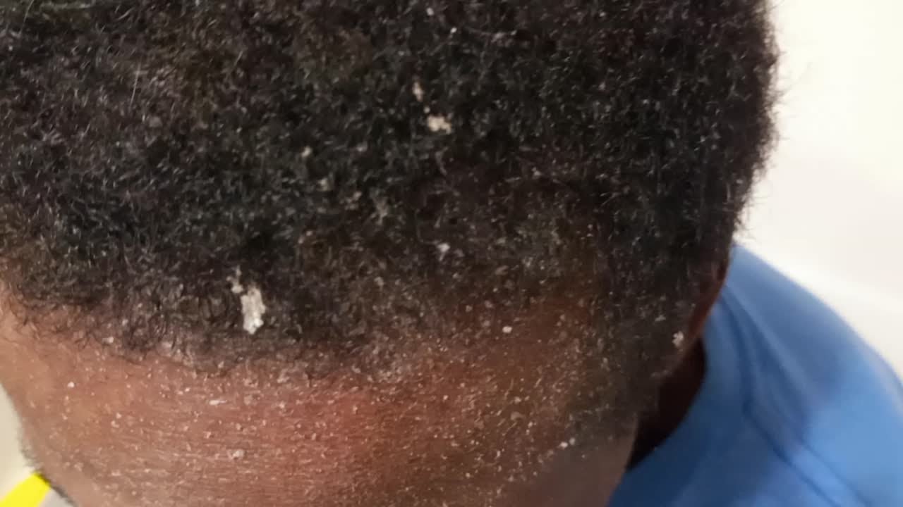 A dandruff flake scratch to relax!!!! - YouTube