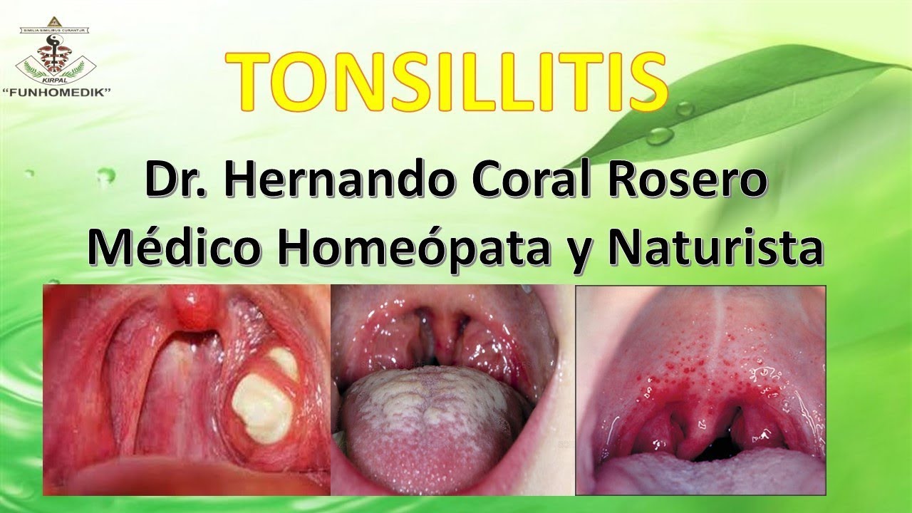 TONSILLITIS-INFLAMACIÓN E INFECCIÓN DE LAS TONSILAS – AMÍGDALAS. - YouTube