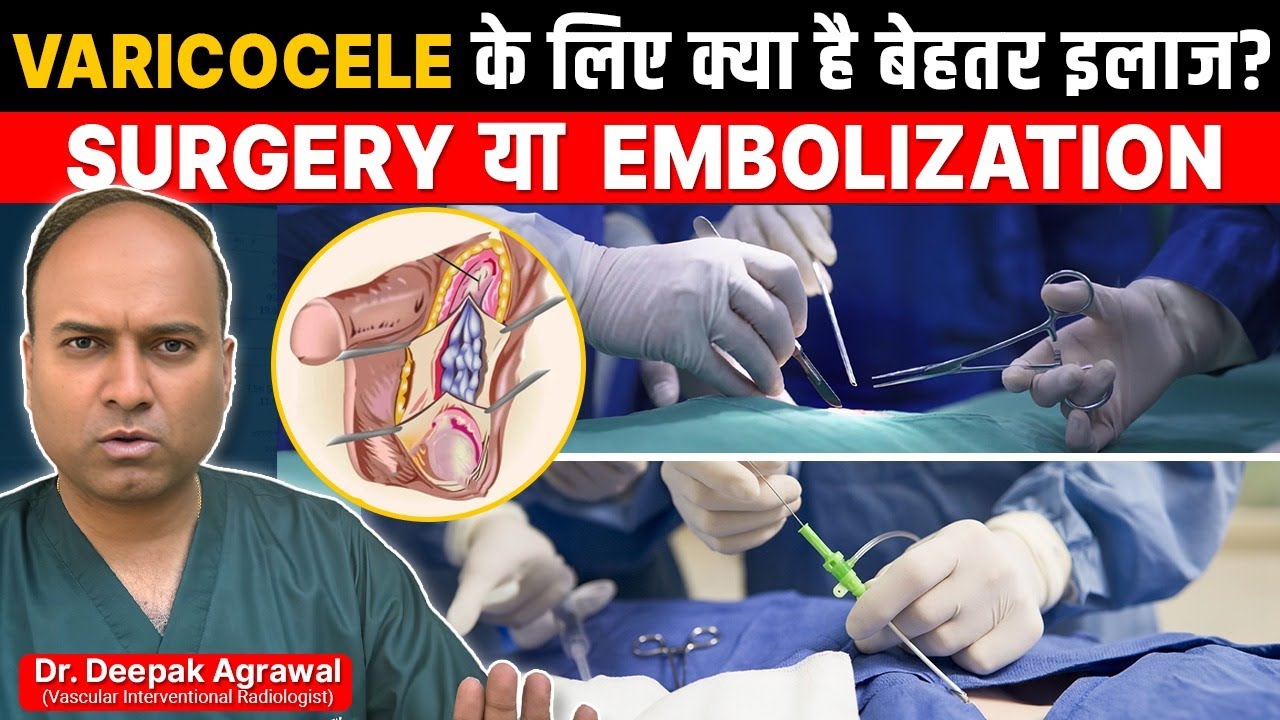 Surgery VS Embolization for Varicocele in Hindi | What is the BEST ...
