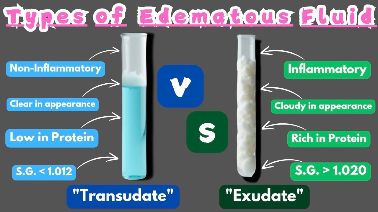 Transudate vs Exudate: Types of Edematous Fluid Explained - YouTube