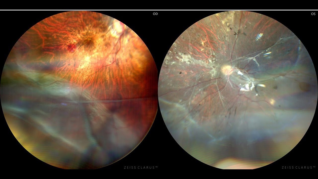 Stickler Syndrome_Retinal Detachment_Giant Retinal Tear - YouTube