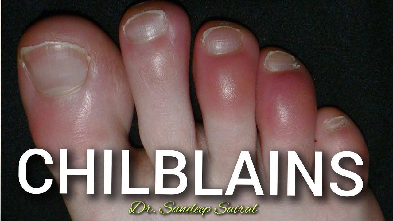 CHILBLAINS ( Dr. Sairal) - YouTube