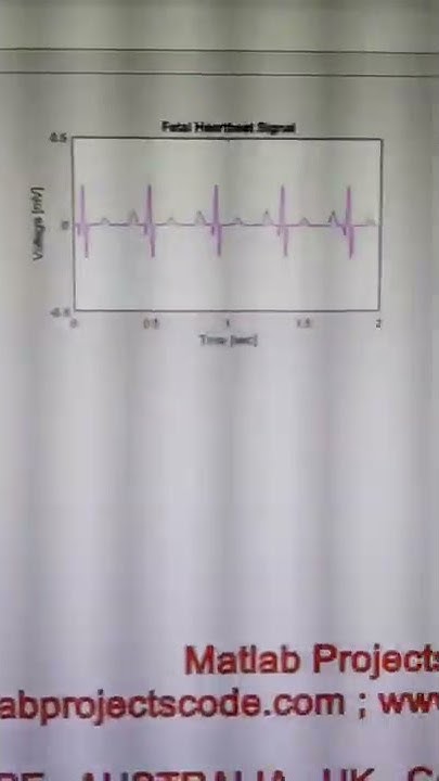 Fetal ECG Extraction Simulink model - FECG - Fetal ECG - ECG -MATLAB ...