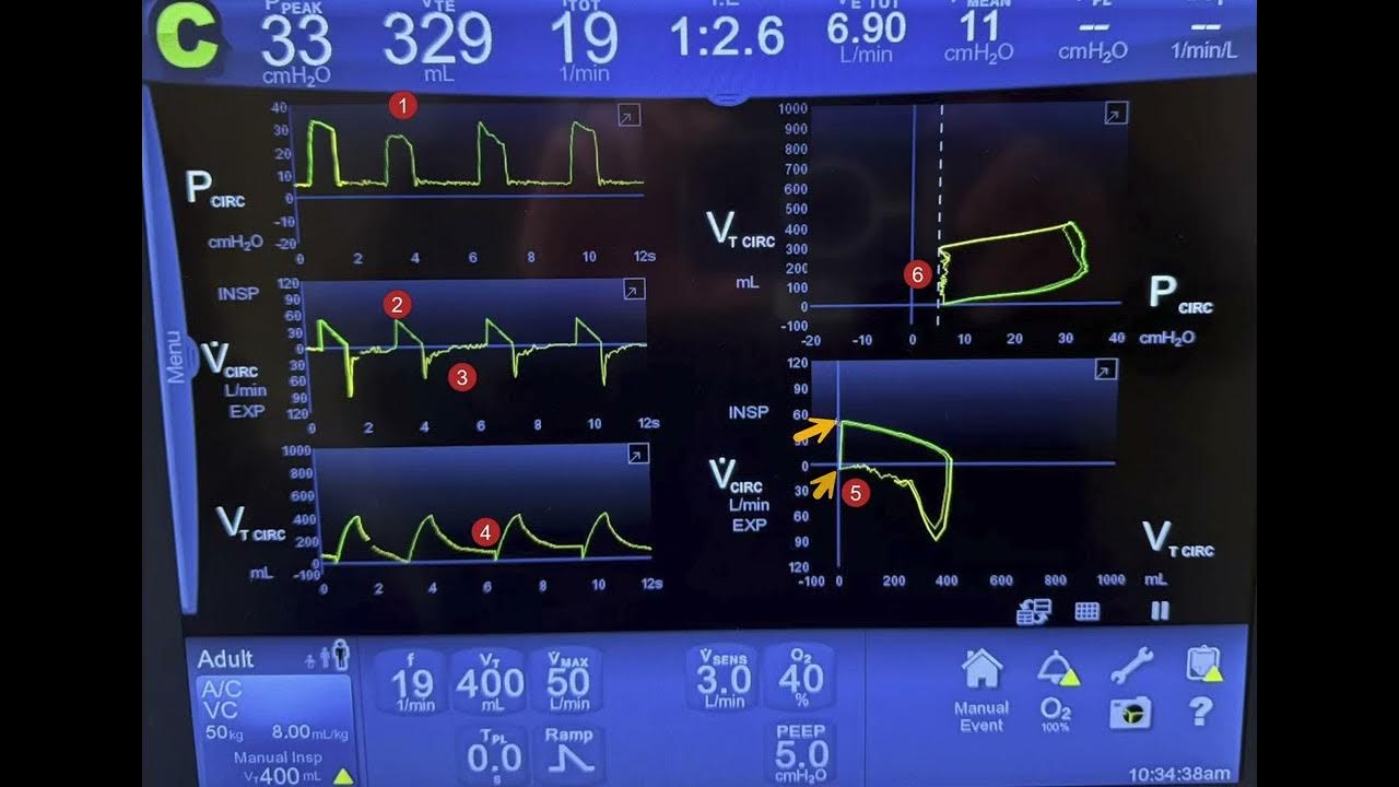 Analysis and Interpretation of Ventilator Graphics Including Loops - YouTube