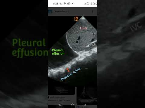 thoracic spine sign on ultrasound - YouTube