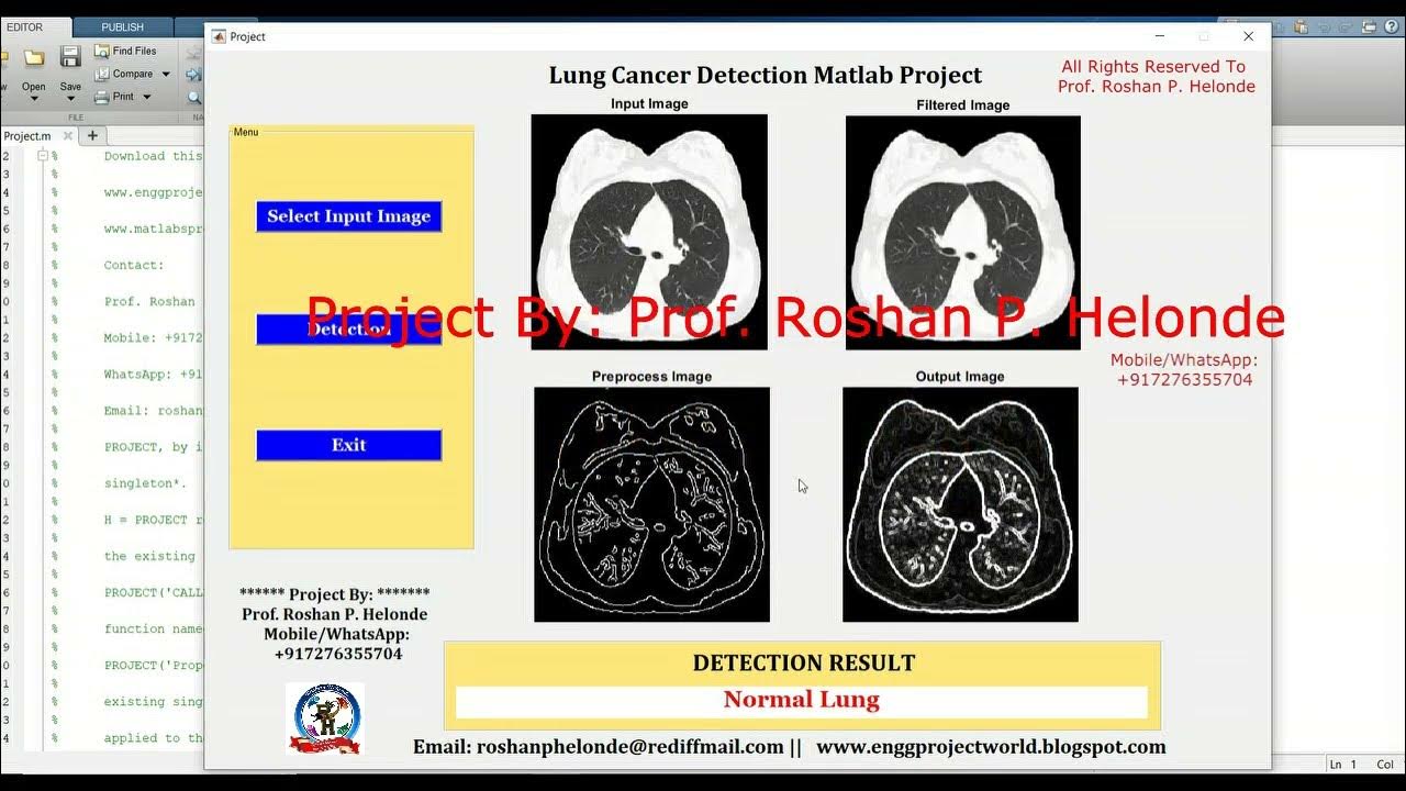 Lung Cancer Detection Using Image Processing Source Code Lung