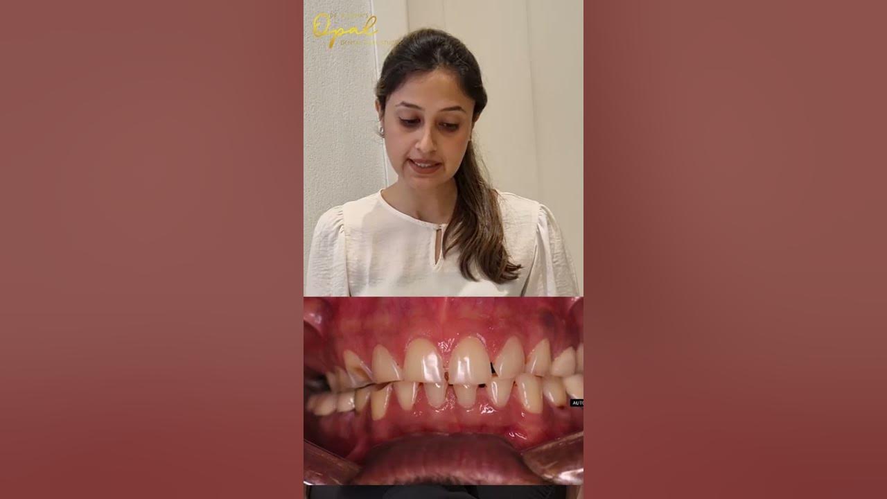 Opal Dental Care Studio| Smile Transformation | Best Dental Clinic For International Patients ...