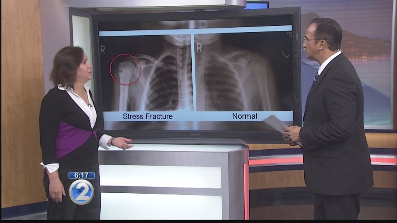 Ask a Specialist: Overuse Injuries in Children - YouTube