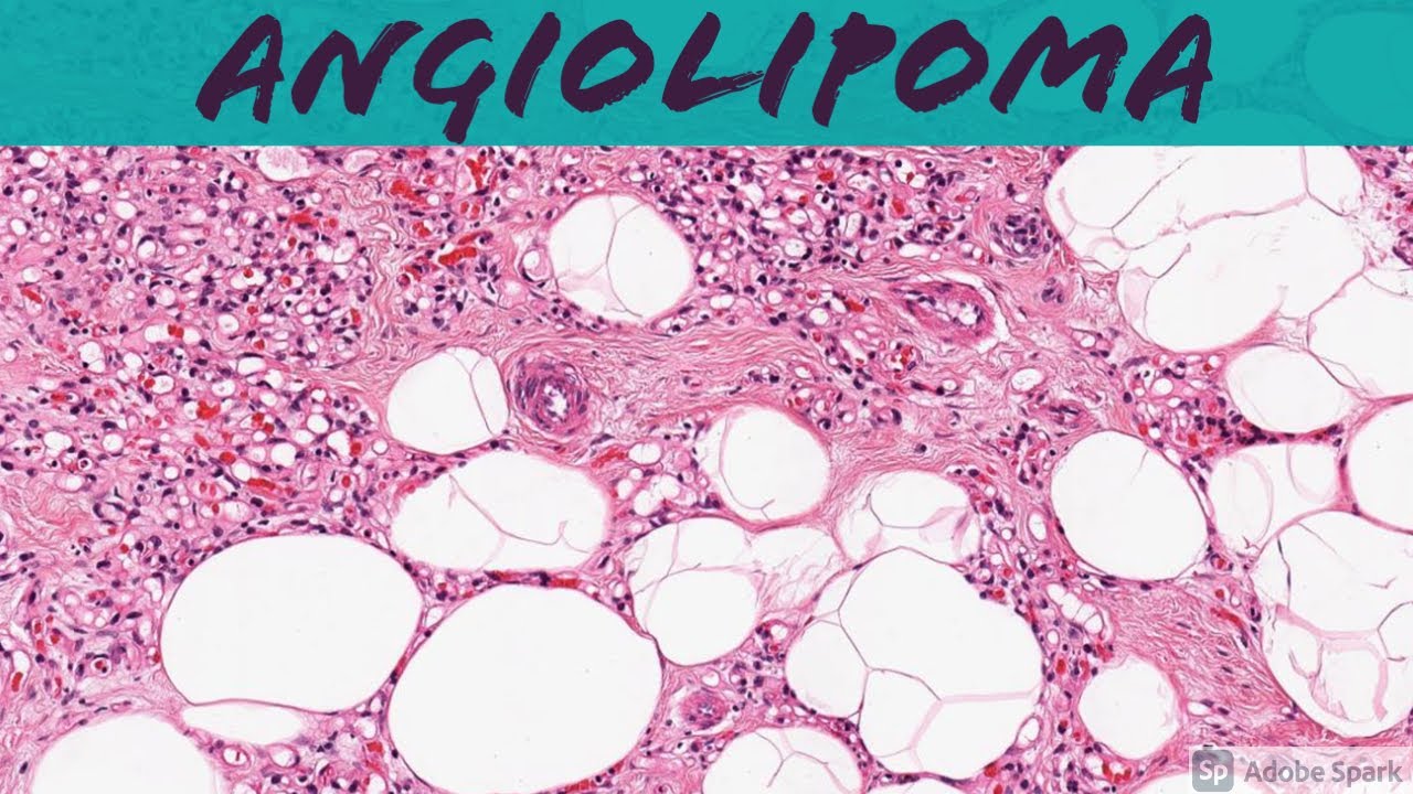 Angiolipoma: 5-Minute Pathology Pearls - YouTube