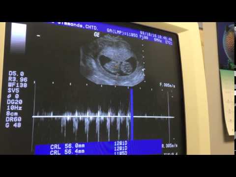 Baby's Heart Beat at 11 Weeks Pregnant