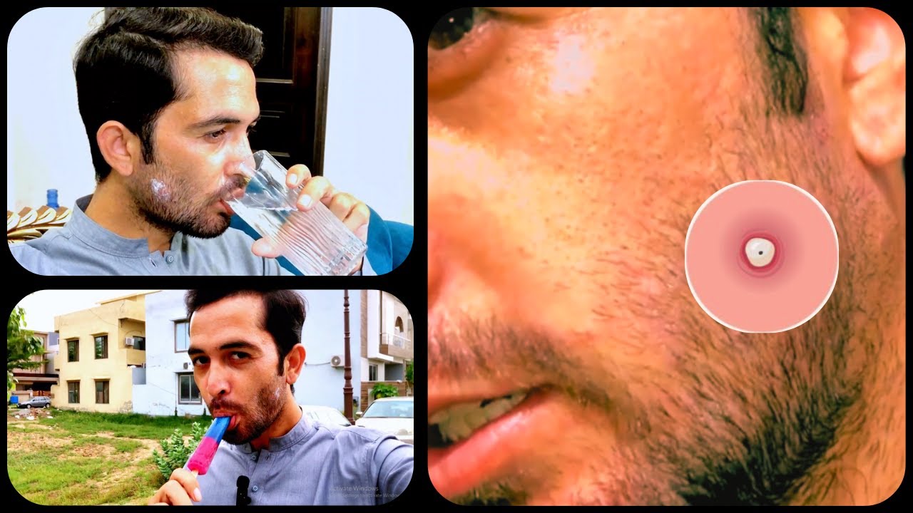 Face pr Bht bada Pimple Nikal Aya😖😥 - YouTube