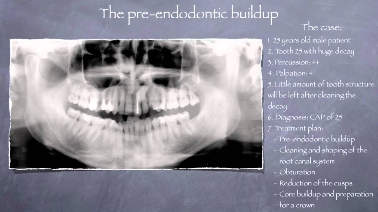 Pre-endodontic buildup - YouTube