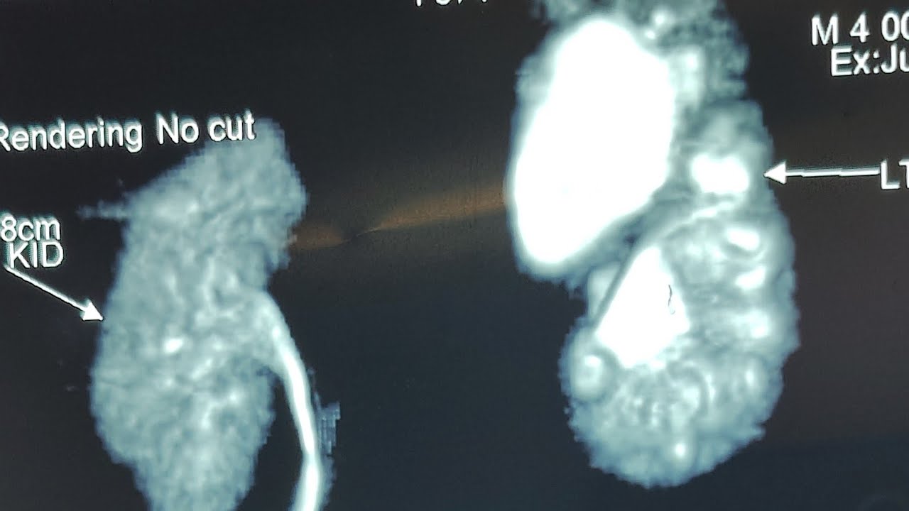 Lap redo pyeloureterostomy duplication @Pediatric-Urologist - YouTube