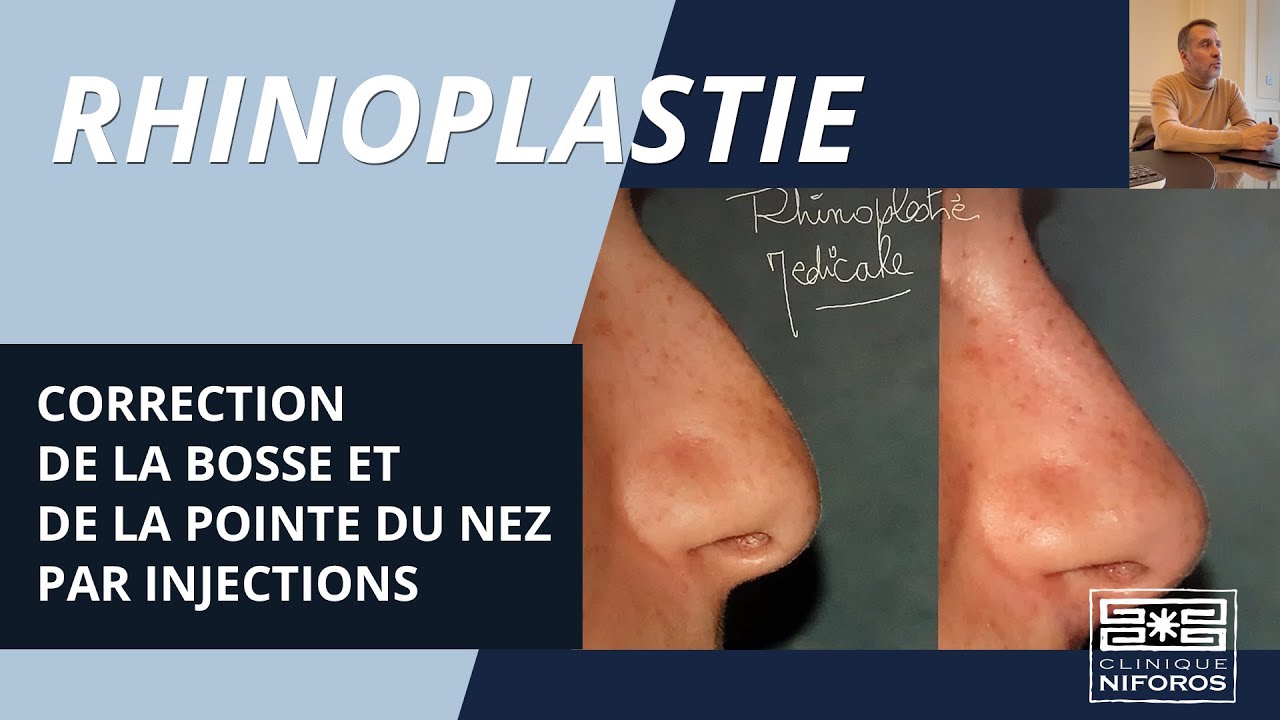 Correction de la bosse et de la pointe du nez par injections ...