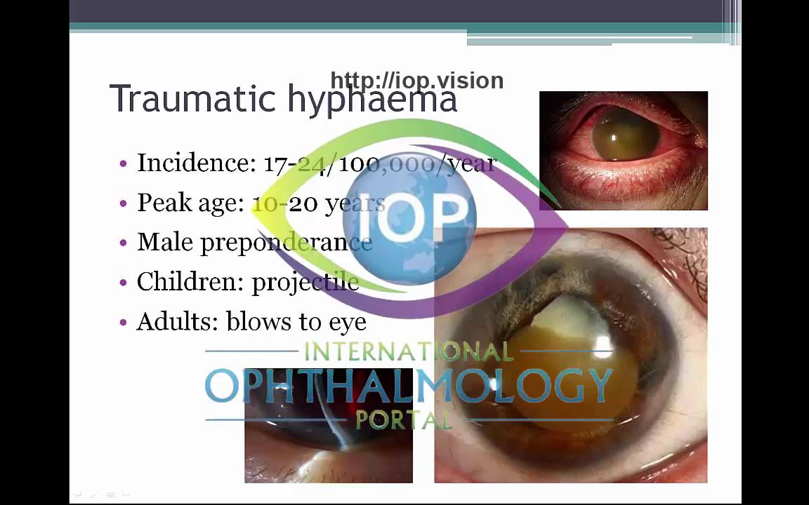 Eightball Hyphaema Preview - YouTube