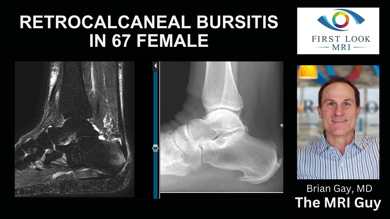 Heel pain from retrocalcaneal bursitis - YouTube