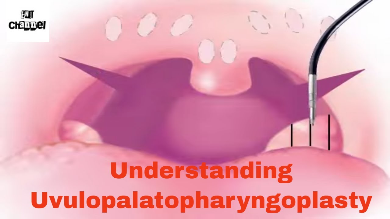 Animated Coblation assisted uvulopalatopharyngoplasty technique - YouTube