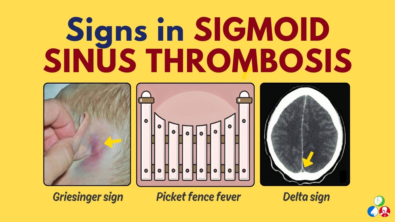 Signs in Sigmoid Sinus Thrombosis | Delta Sign, Griesinger Sign and ...