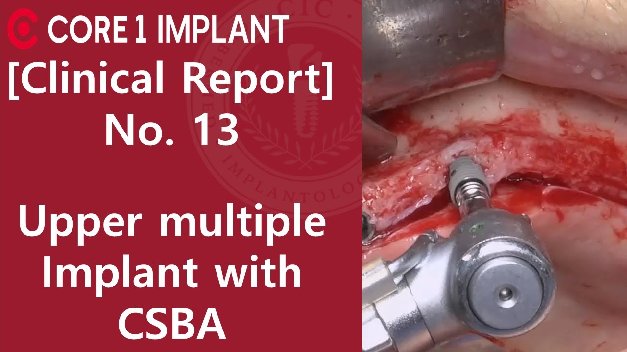 [CYBERMED Clinical Report] Upper multiple implant placement with ...