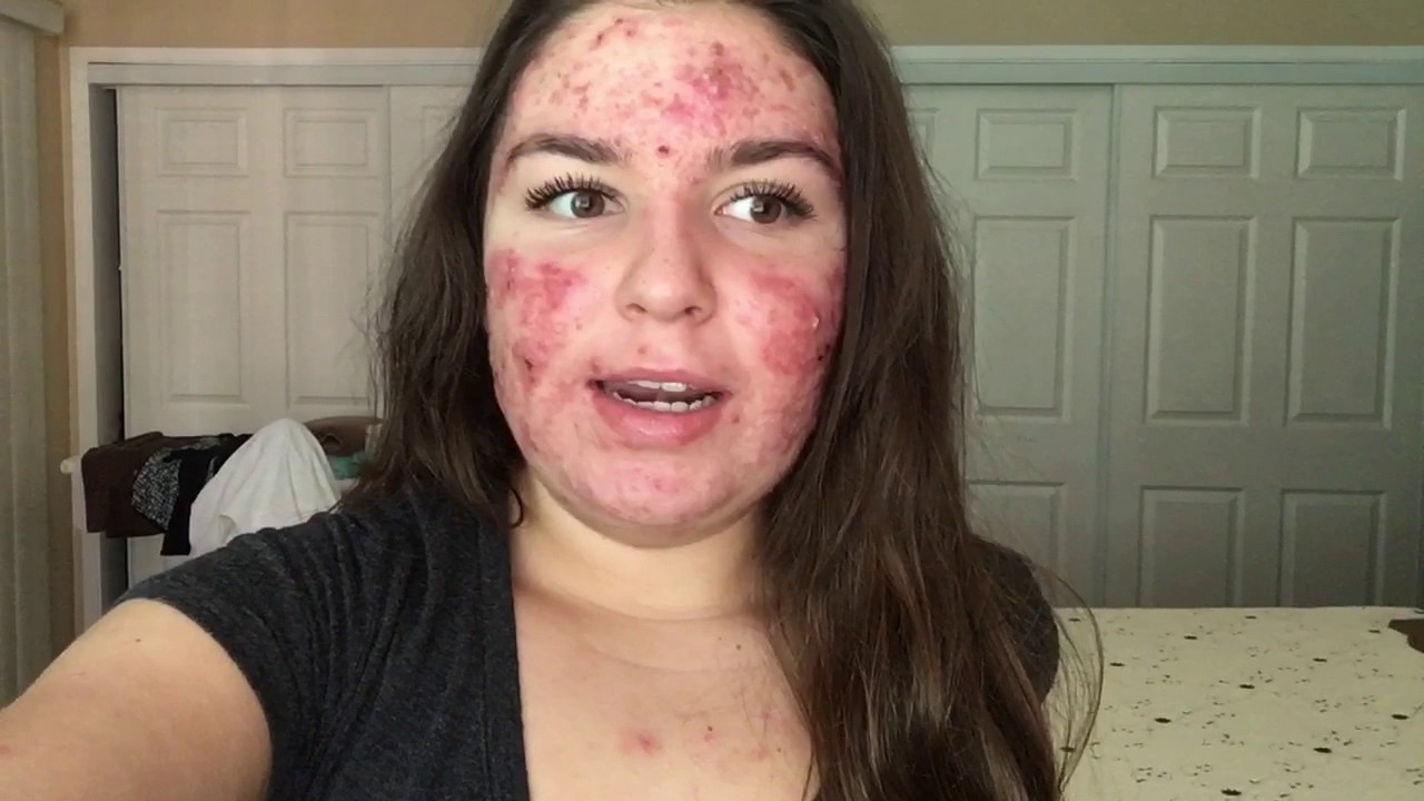 Accutane vlog || week five - YouTube