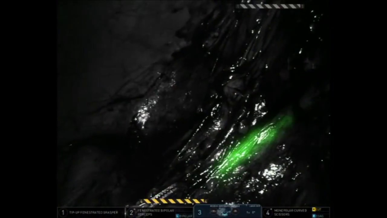 Firefly ICG identifiection of ureters - YouTube