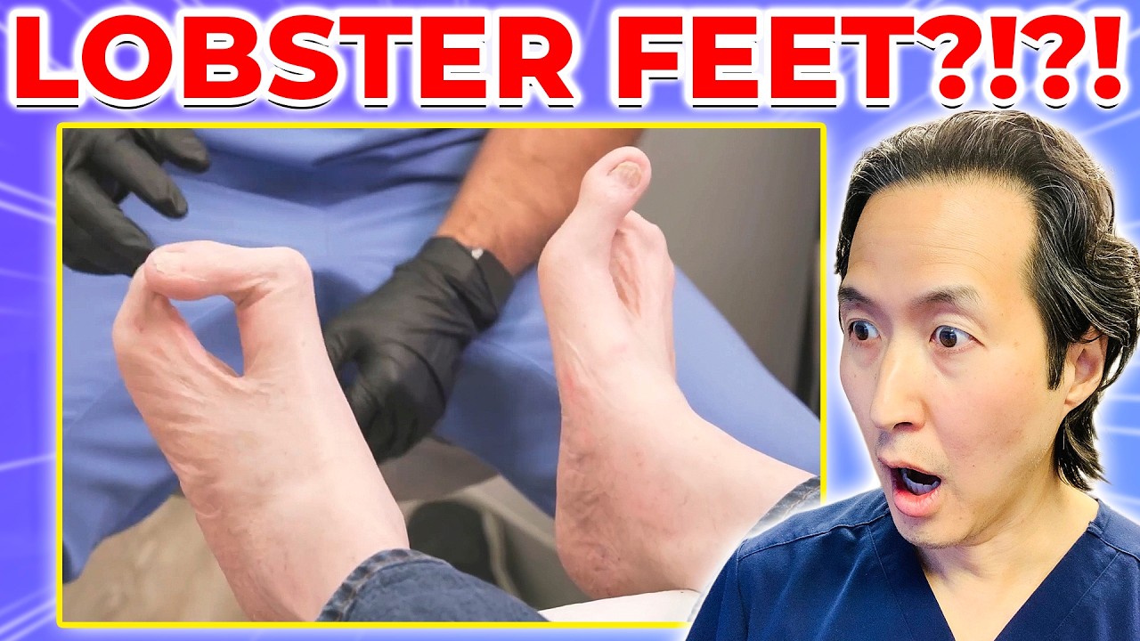 His Hands and Feet Resemble LOBSTER CLAWS?!?! Doctor Reacts to My Feet ...