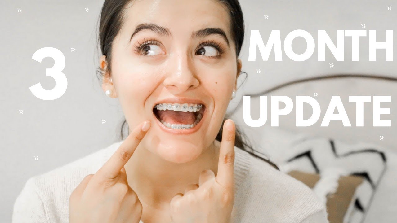 Juliezeneth⎮3 Month Braces Update Youtube