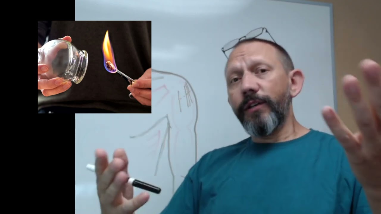 Cupping placement for shoulder pain and rotator cuff - YouTube
