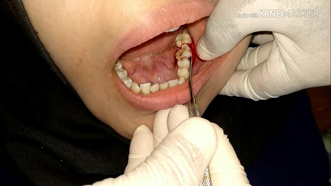 Pencabutan Gigi Geraham Bawah|Cabut Gigi Bawah Kiri Belakang - YouTube